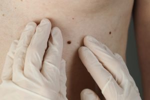 Do Skin Tags Grow Back? - Singapore Dermatologist